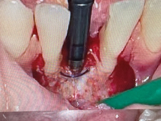 Revolutionising Bone Grafting | EthOss Dental