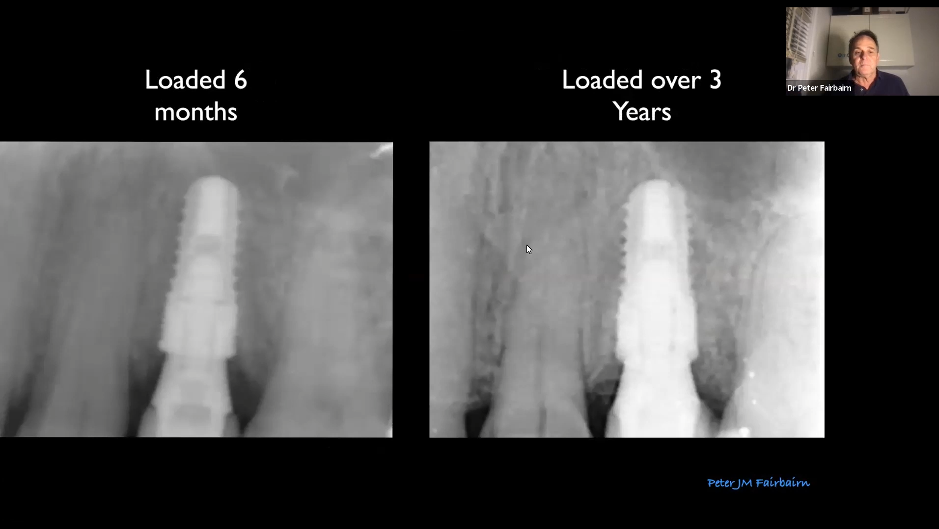 Long-term Outcomes with EthOss: True Host Bone Regeneration | EthOss Dental