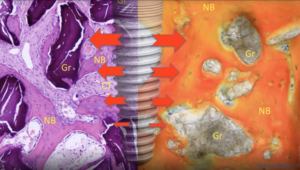 Managing Emergence Profiles with EthOss | EthOss Dental